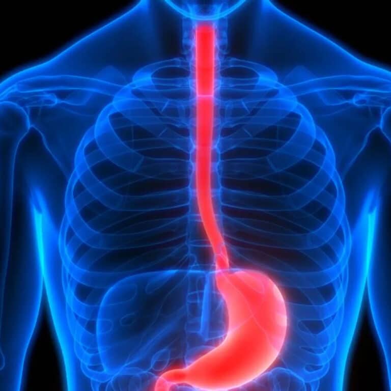 Esófago de Barrett - Gastroenterologo Ciudad de Mexico